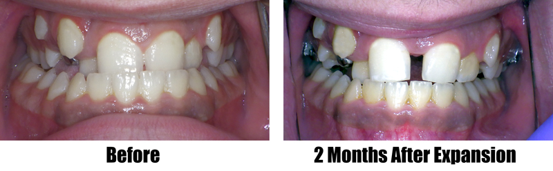 IOS Ortho. MARPE manufacturer MSE MARPE expander screw mini implant RPE