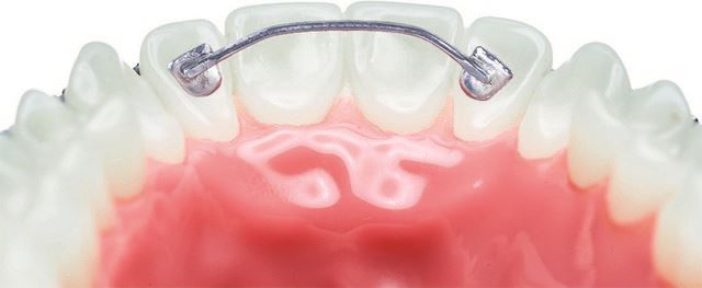 IOS Ortho. Lingual Retainers 2&2 Kit - Kit