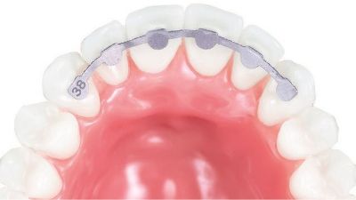IOS Ortho. Lingual Retainers 3To 3 37 mm Lower Size - PK/2