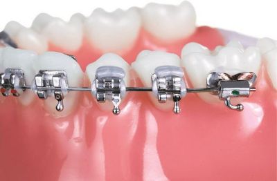 IOS Ortho. Bracket Guard Elastic - Clear - PK/100